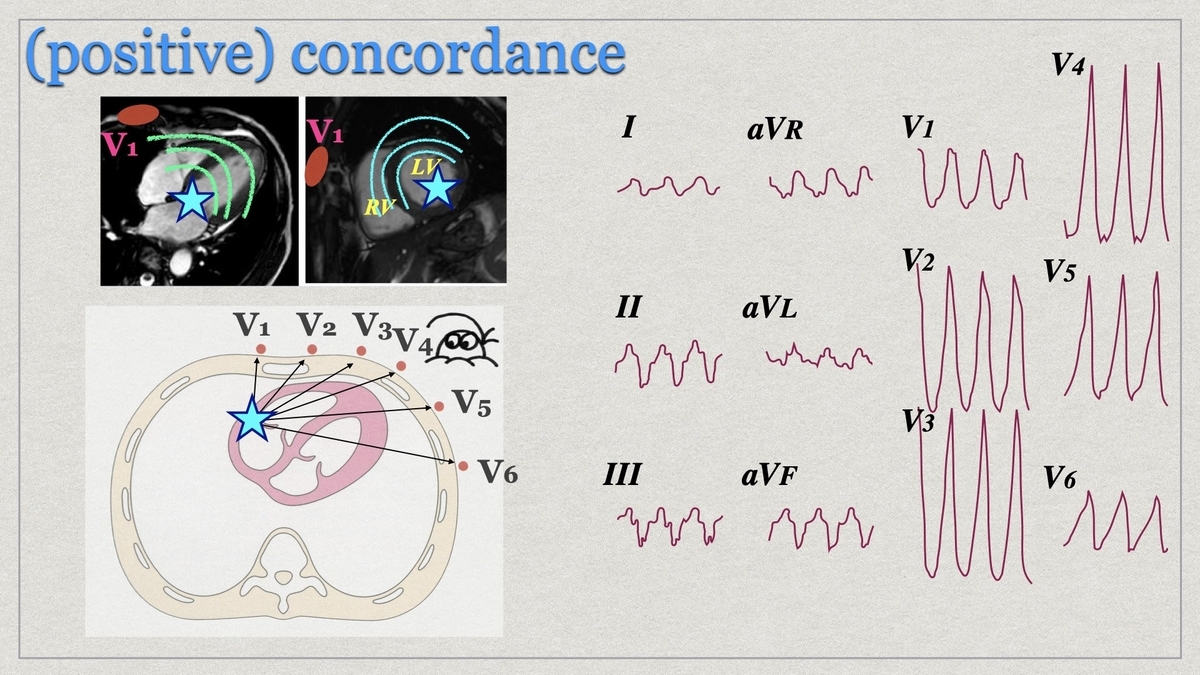 【コラム-151 前編：あしたのために その8-SVT vs VT】 - Cardio2012のECGブログ-2019改