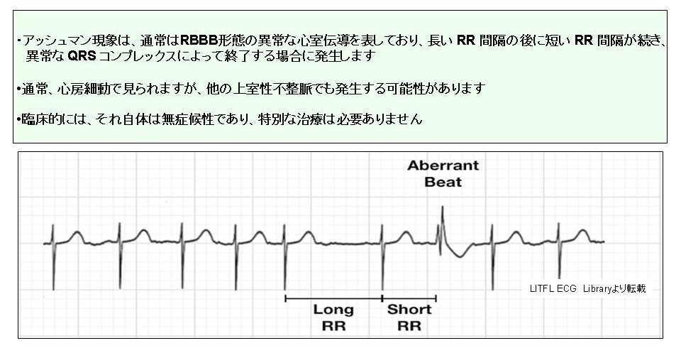 悩ましいのは変行伝導～AB・C（ABerrant・Conduction）を考える - ホルター心電図 四方山話