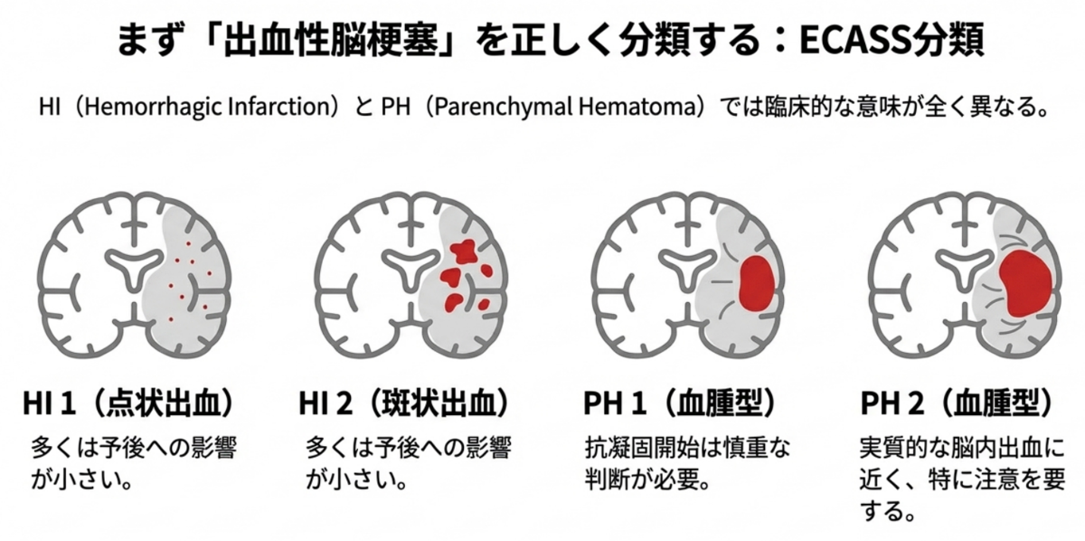 出血性脳梗塞を伴う心原性脳塞栓症：抗凝固療法開始の考え方 - 医知創造ラボ ～脳神経内科医がAIで紡ぐ最新医療情報～