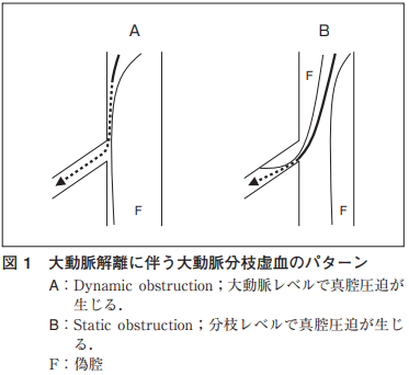 大動脈解離 ステントグラフト内挿入術 - From おぺかん