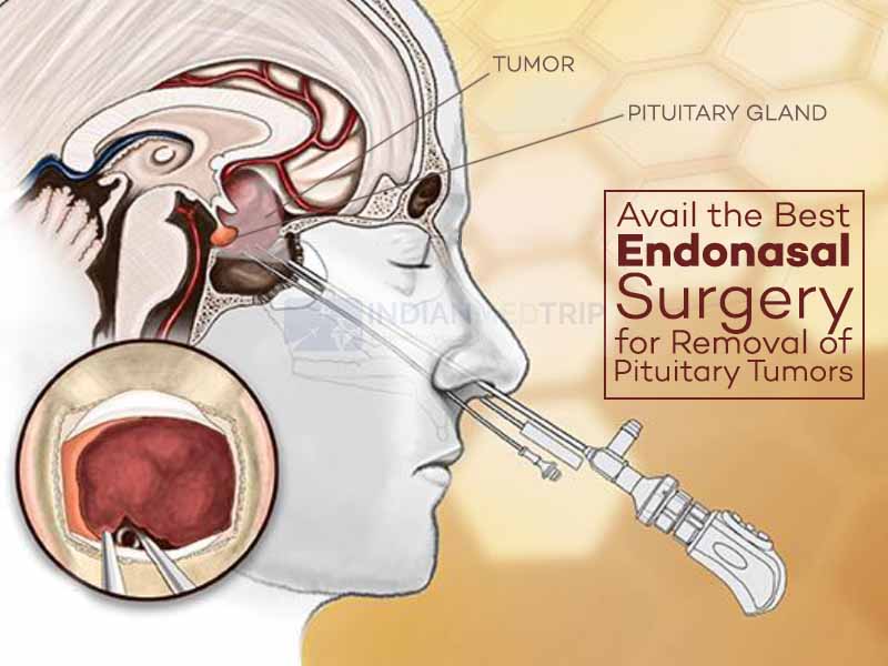 Avail the Best Endonasal Surgery for Removal of Pituitary Tumors ...