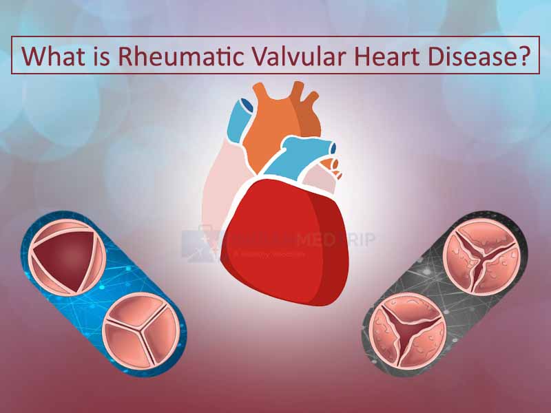 What is Rheumatic Valvular Heart Disease - indianmedtrip’s blog