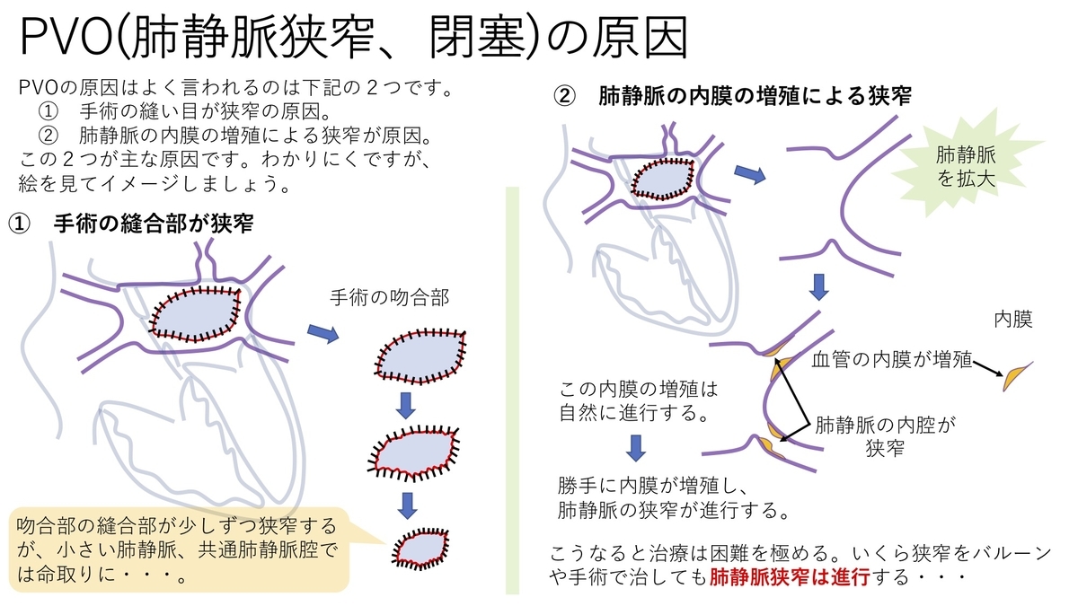 総肺静脈還流異常(TAPVC, TAPVR)について PVO:(PVS肺静脈狭窄)について 疾患35 - 誰でもわかる先天性心疾患