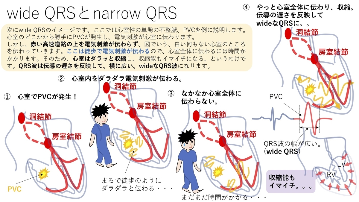 不整脈：wide QRSついて 〜基本26〜 - 誰でもわかる先天性心疾患