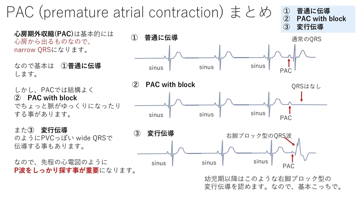 不整脈：心房性期外収縮(PAC)について 〜基本41〜 - 誰でもわかる先天性心疾患