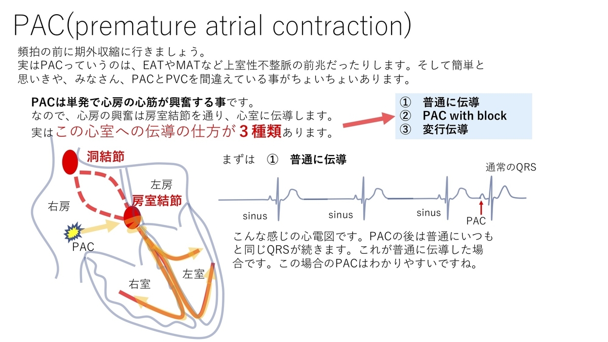 不整脈：心房性期外収縮(PAC)について 〜基本41〜 - 誰でもわかる先天性心疾患