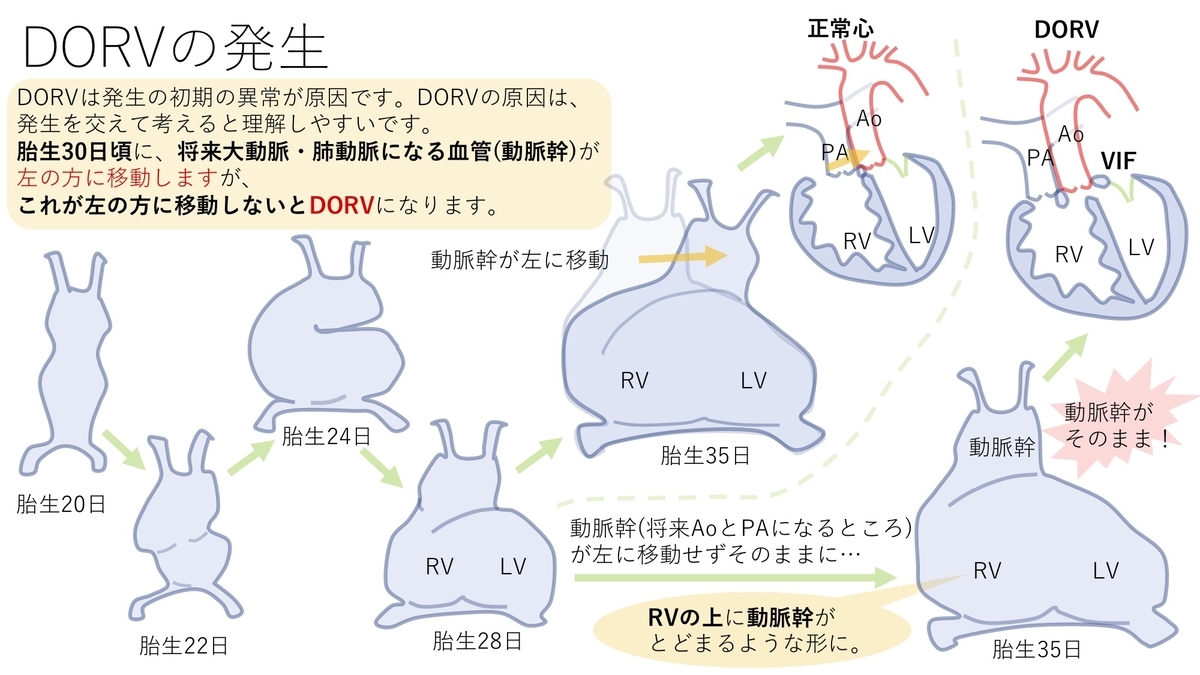 両大血管右室起始症（DORV）について その1 定義や成り立ちなど 〜疾患36 - 誰でもわかる先天性心疾患