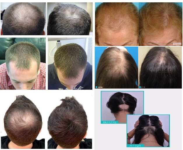 Capillus(カピラス）272の日本の回復例と継続使用での維持 - 低出力レーザ―育毛をはじめとした世界最先端のAGA 男性型脱毛症 女性 ...