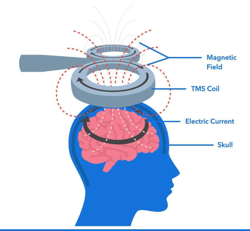 脳を直接刺激するニューロモデュレーション技術の発展 - Neuralism（by 奥田一貴）