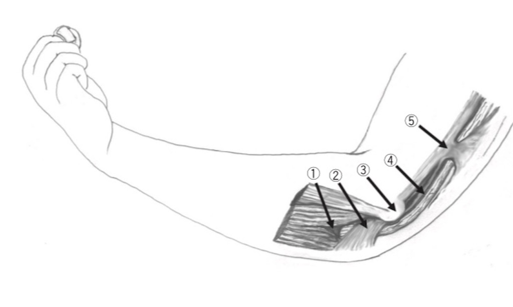 肘部管症候群の施術 - kiteibuのブログ