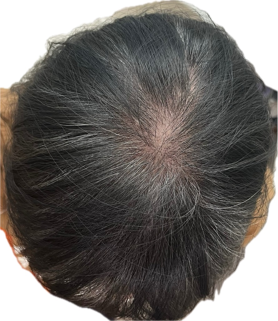 【103日目】ウィッグユキのヘアファンデーション《ミノキ経過観察》 - ミノキ生活、始めました。
