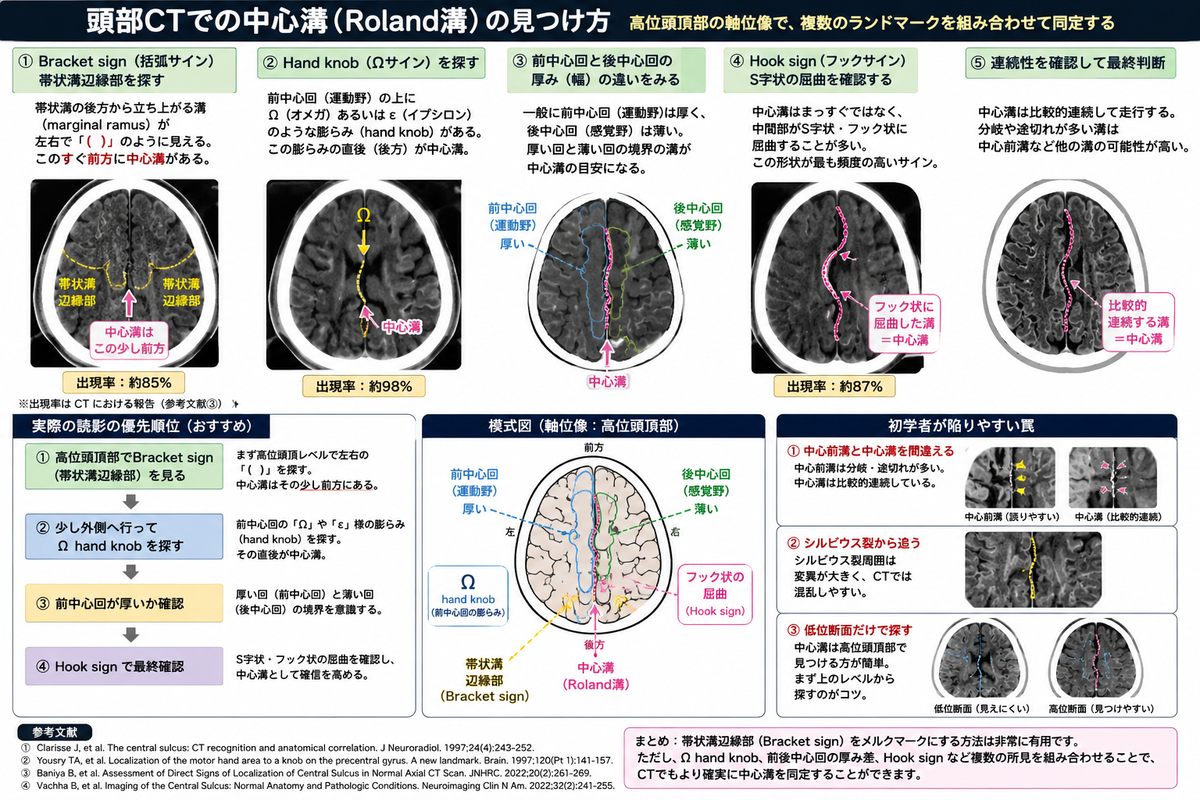 【続編】頭部CT 中心溝（ローランド溝）の見つけ方 ※画像生成 - 生成AI de 臨床疑問