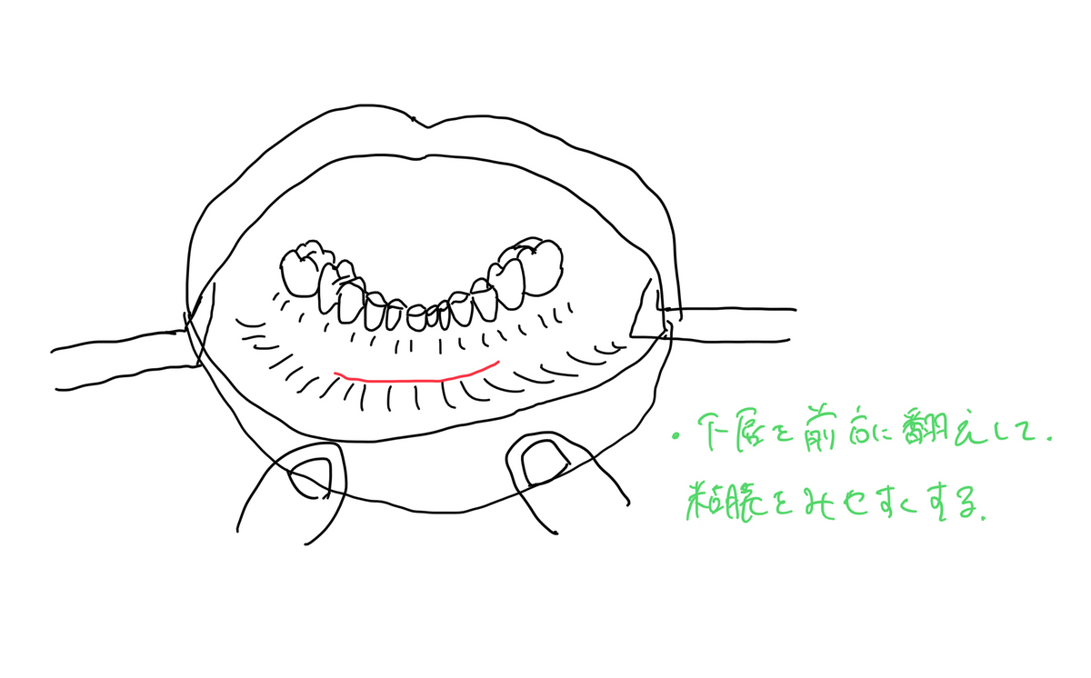 下顎骨骨折に対する観血的整復固定術の術式 - 出来損ないの口腔外科研修医が学んだ事