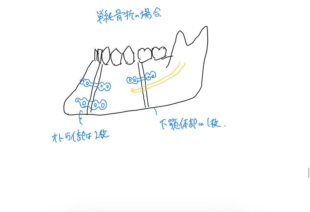 下顎骨骨折に対する観血的整復固定術の術式 - 出来損ないの口腔外科研修医が学んだ事