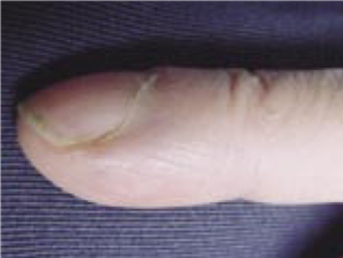 爪は語る - リウマチ膠原病のQ&A