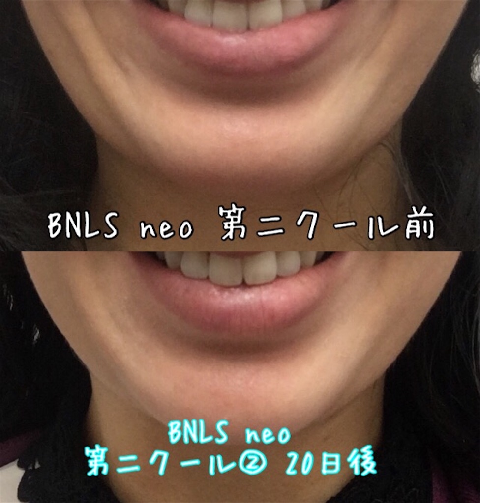 BNLS neo 第2クール2回目[完]（ビフォー／アフター） - ビューティーをぷんぷんさせたい