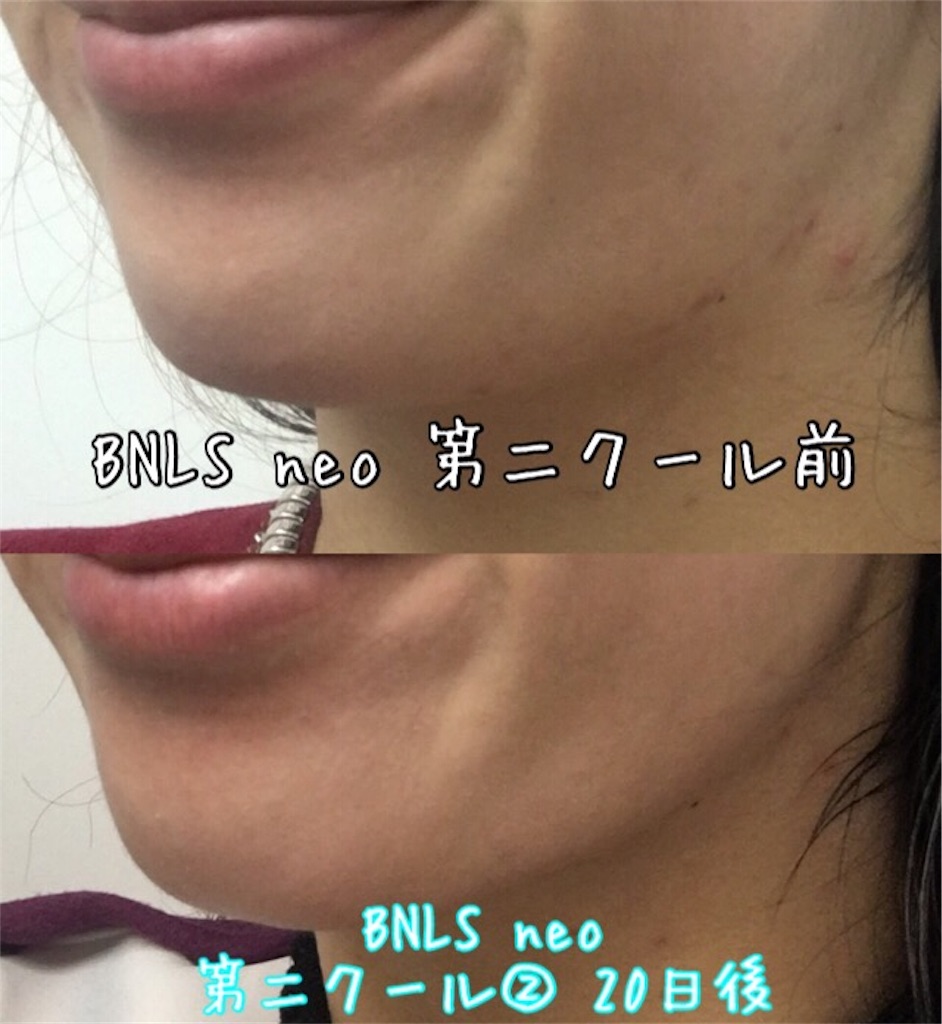 BNLS neo 第2クール2回目[完]（ビフォー／アフター） - ビューティーをぷんぷんさせたい