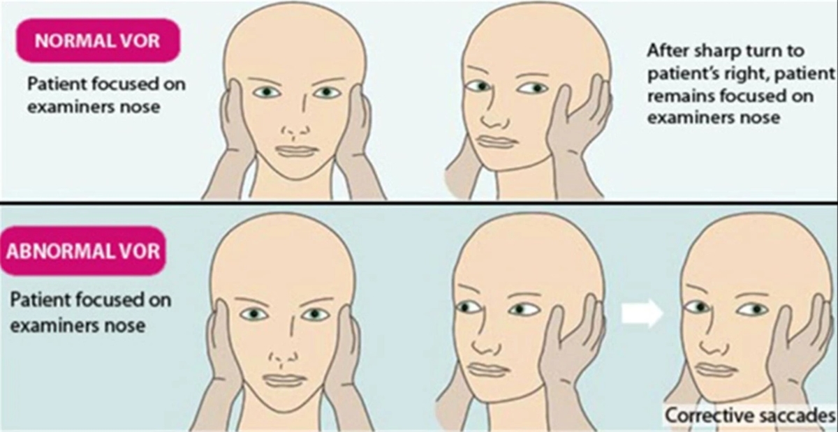 めまいの診療 - 内科医キューピーのつぶやき