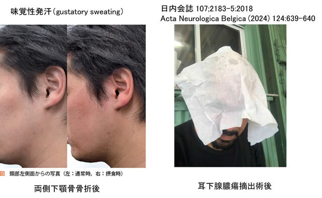 味覚性発汗とFrey症候群とホロコースト - Neurology 興味を持った「脳神経内科」論文