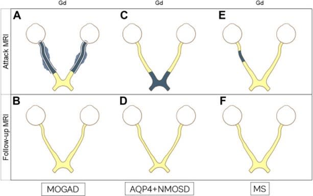 MOG抗体関連疾患（MOGAD）と視神経脊髄炎（NMOSD）と多発性硬化症（MS）のMRIによる鑑別ポイント - Neurology 興味を ...