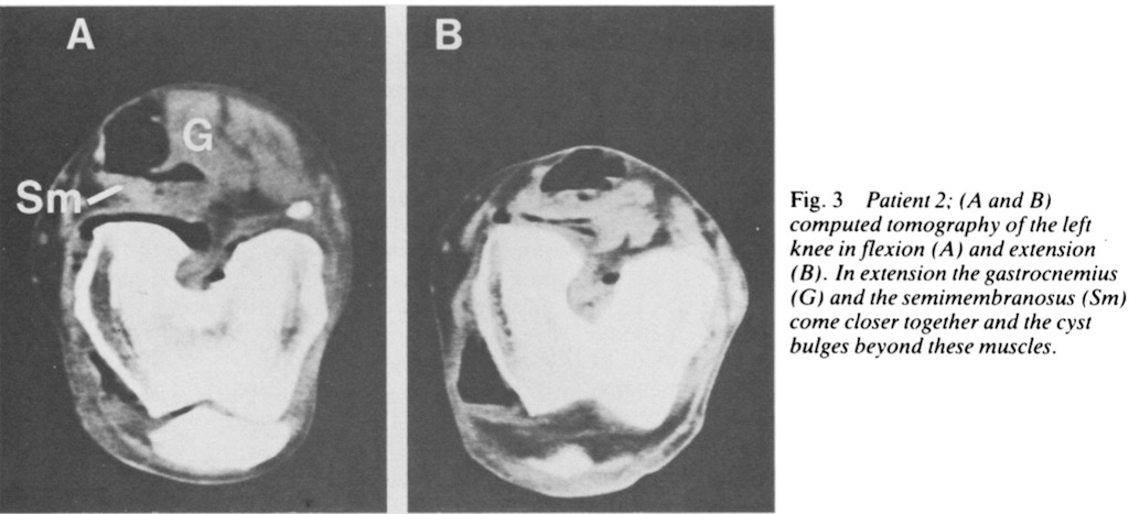 Foucher's signとCrescent signの違い - とある初期研修医の勉強記録