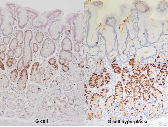 G cell, gastrin, pyloric gland, G cell hyperplasia - 胃生検の小部屋 Cottage ...