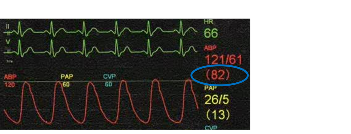 動脈圧波形の意味 Aライン波形 - さちこのナース勉強blog