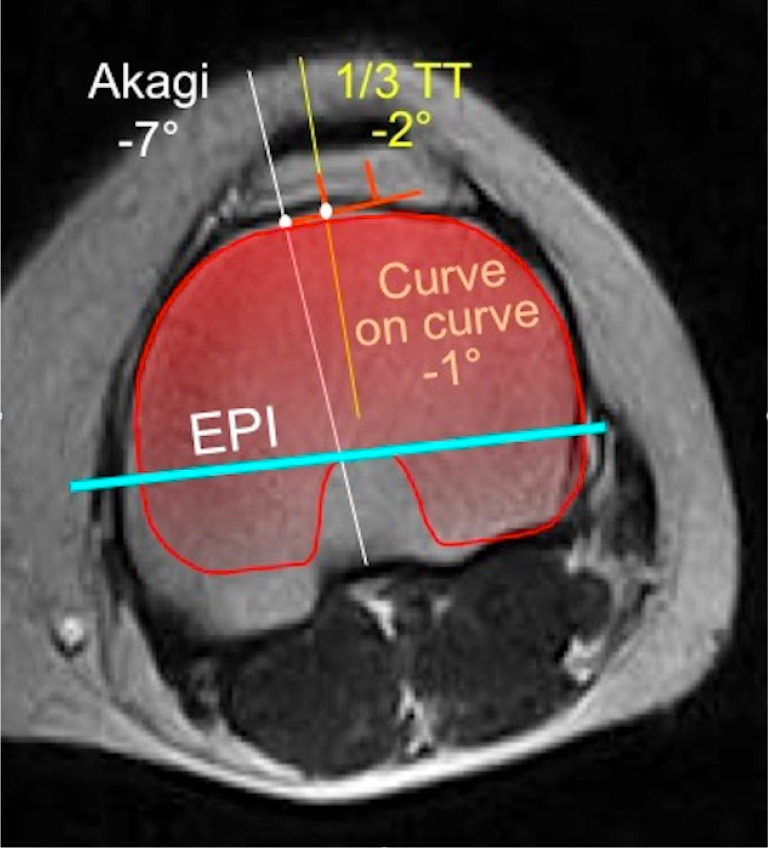 Akagi line TKA作図 - Daily Orthopedics ~整形外科チャンネル~
