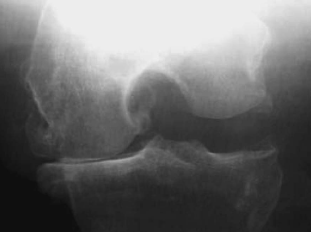 TKA作図 大腿骨側におけるアライメントの指標，PCA，CEA，SEAとは - Daily Orthopedics ~整形外科チャンネル~