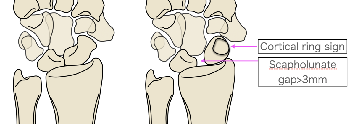 手根不安定症 −VISI，DISIとは，整形外科専門医試験にもでます！− - Daily Orthopedics ~整形外科チャンネル~