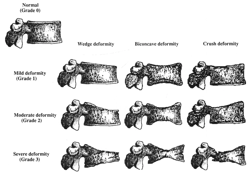 胸腰椎レントゲン写真のみかた−特に腰椎圧迫骨折について− - Daily Orthopedics ~整形外科チャンネル~