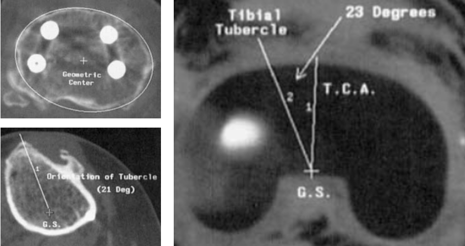 Akagi line TKA作図 - Daily Orthopedics ~整形外科チャンネル~