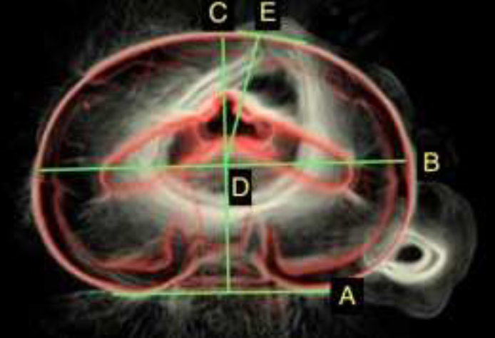 Akagi line TKA作図 - Daily Orthopedics ~整形外科チャンネル~