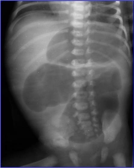 シングルバブル、ダブルバブル、トリプルバブルサインの違い - つねぴーblog＠内科専門医