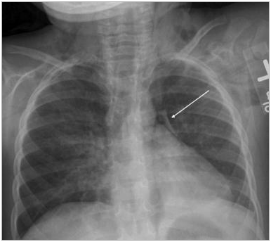 胸部レントゲンで読影する順番 – とある内科医の雑記帳