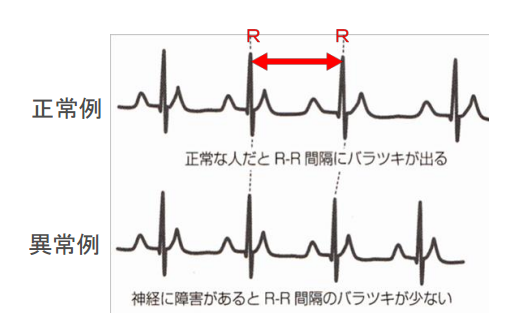 糖尿病でCVRRが低下する理由 - つねぴーblog＠内科専門医