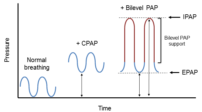 CPAPとBIPAPの違い - つねぴーblog＠内科専門医