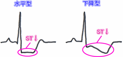 心筋梗塞を疑うST低下のパターン - つねぴーblog＠内科専門医