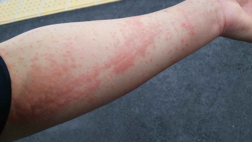 かゆい - 鷄冠力