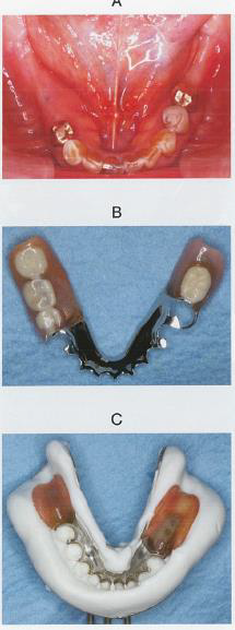 115回歯科医師国家試験【115D-39】義歯 取り込み印象編 - 歯学部オンライン予備校TIDブログ「歯科材料のツボ」