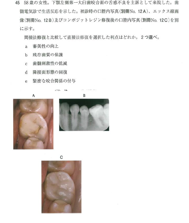 117回歯科医師国家試験【117d 45】保存修復学：直接法と間接法の比較 歯学部オンライン予備校tidブログ「歯科材料のツボ」 8290