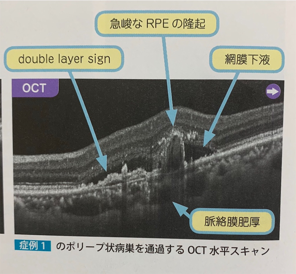 【専門医試験対策】ポリープ状脈絡膜血管症(PCV) - 眼科専門医試験対策ブログ